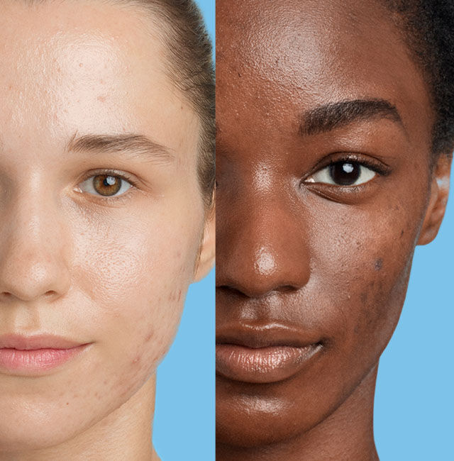 Acne Positivity | La Roche-Posay